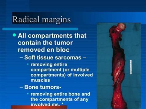 Role Of Limb Salvage In Malignant Bone Tumors Pptx