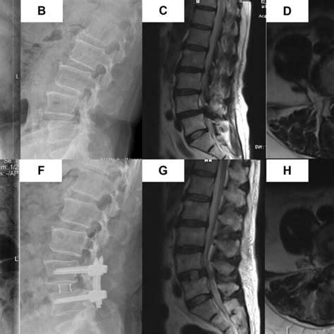A Typical Case Of Olif A B The Preoperative Anteroposterior And