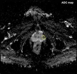 Multiparametrisches MRT Der Prostata MpMRT 3D Stereotaktische