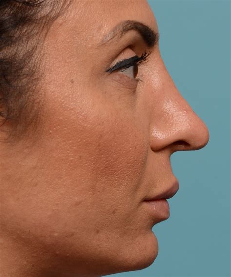 338 Rhinoplasty Dr Oakley Smith Toronto Nose Job Toronto