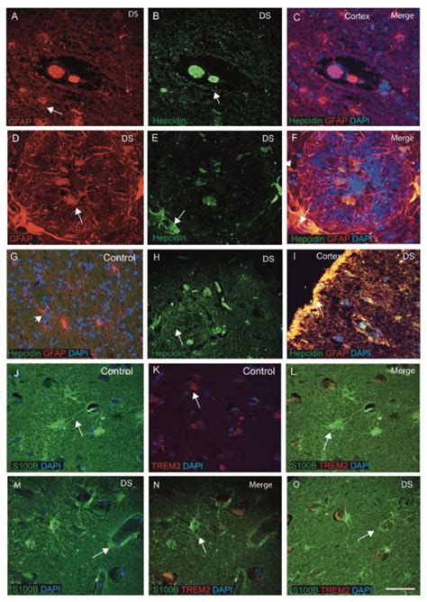 Hepcidin And S100β Positive Activated Damaged Astrocytes Seen Around