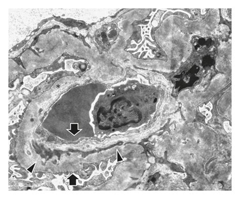 Electron Microscopy Revealed Wrinkling Of The Glomerular Basement