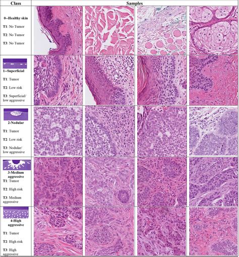 Samples Of Bcc Subtypes Used In The Three Classification Tasks T T1