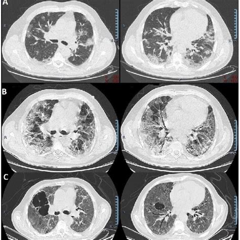 Thorax Ct Scan A At Admission Diffuse Consolidation In The