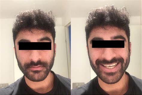 Been Chewing Falim Gum To Improve Jawline For A Few Weeks Now But Seem