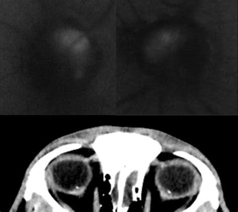 Bilateral Parainfectious Papillitis Superimposed On Papillary Pseudoedema By Optic Nerve Drusen