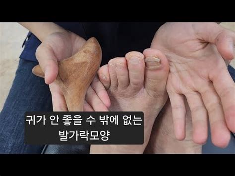 귀가 안 좋을 수 밖에 없는 발가락 모양 YouTube