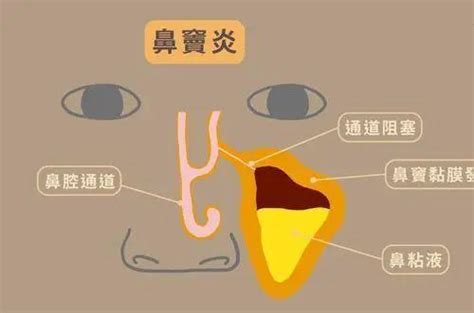 带你了解慢性化脓性鼻窦炎有哪些临床症状表现？ 知乎