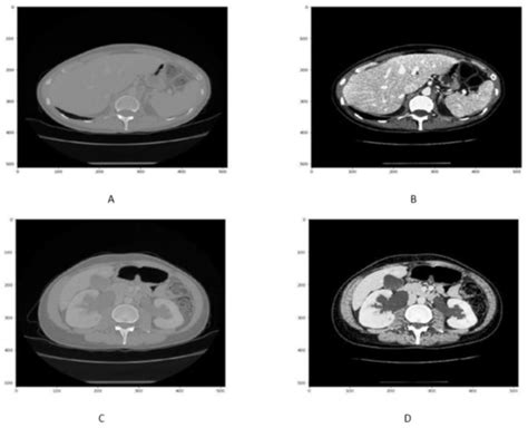 Segmentation Of Liver Tumor In CT Scan Using ResU Net
