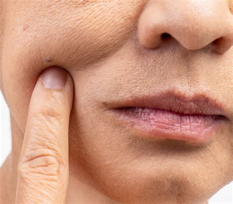 Skin Laxity Treatment In Portland Or Key Laser Institute