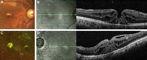 Delayed Macular Hole With Inverse Pseudohypopyon Post Silicone Oil Removal Ophthalmology Retina