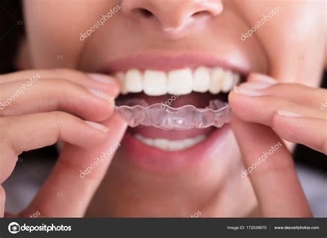 Woman Putting Transparent Aligner Stock Photo By AndreyPopov