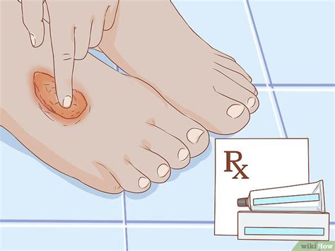 3 Formas De Tratar Una Quemadura Infectada Wikihow