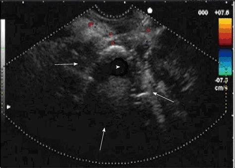 Endoscopic Ultrasonography Image Of Walled Off Necrosis Collection The