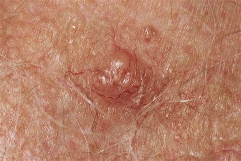 Hautkrebs Symptomen Behandlung Diagnose Und Vorsorge