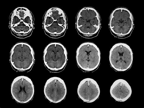 Brain Anatomy On CT Axial Landmarks Normal Brain CT Thi Flickr
