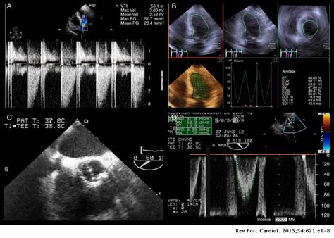 Severely Impaired Lv Systolic Function Iucn Water