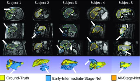 Examples Of The Superior Liver Segmentation Performance Of The