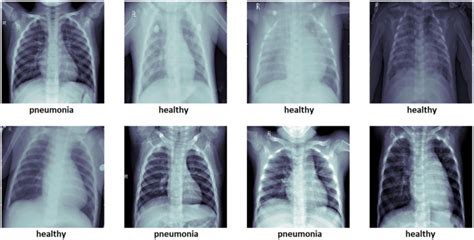 Detection Of Pneumonia Using Convolutional Neural Networks And Deep Learning Bohrium