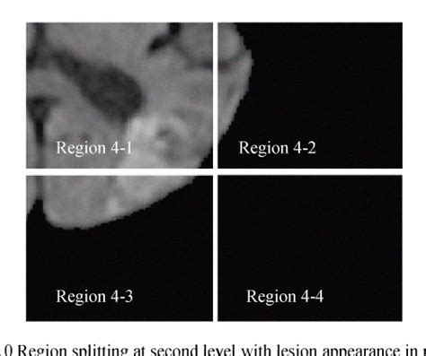 Figure 10 From Automated Segmentation Of Brain Lesion Based On Diffusion Weighted Mri Using A
