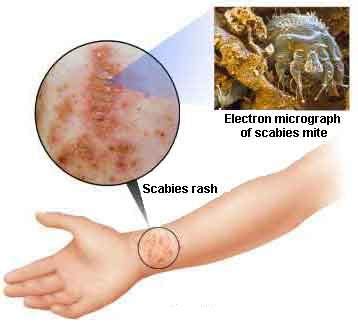 Healthy Life Style Foods Habits Fitness Exercises Scabies Rash