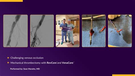 Inari Medical On Linkedin Venacore Thrombectomy Revcore
