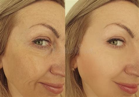 Woman Face Wrinkles Beautician Procedure Before And After Collage Treatment Stock Image Image