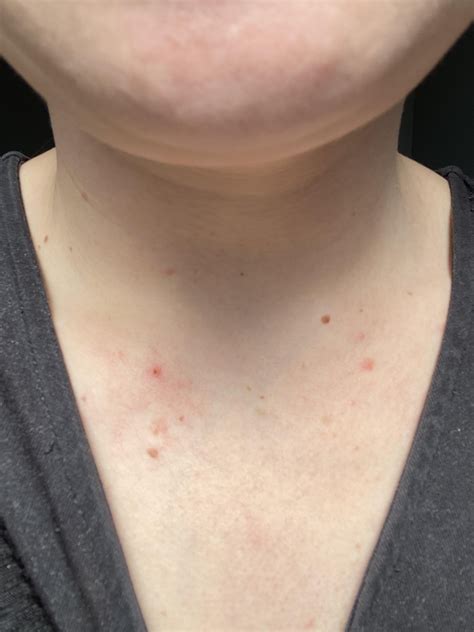 Red Spots On Face And Neck Rausskincare