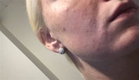 [skin Concerns] Allergic Reaction Or Breakout R Skincareaddiction