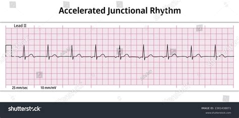 Junctional Rhythm Photos And Images