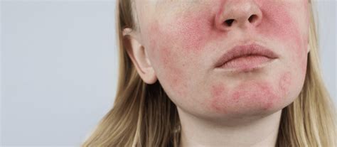 Rosacea Anne Arundel Dermatology