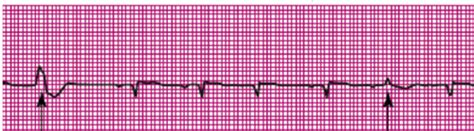 ECG Chapter 6 Ventricular Rhythms Flashcards Quizlet