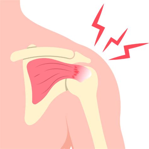Rotator Cuff Tears Eramosa Physiotherapy