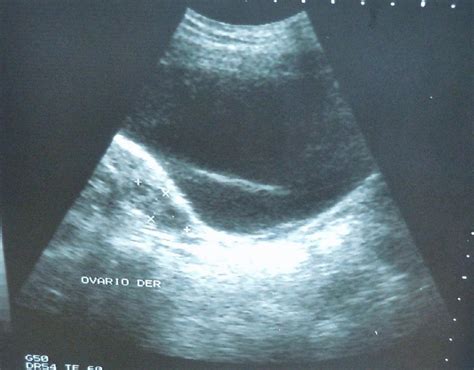 Paraovarian Cyst With Septum Download Scientific Diagram