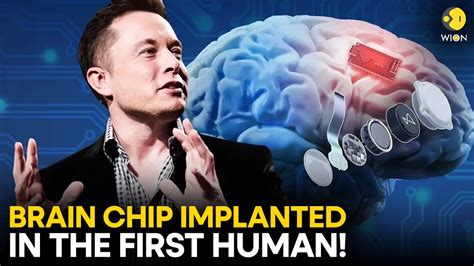 Elon Musks Neuralink Implants Brain Chip In Human For The First Time