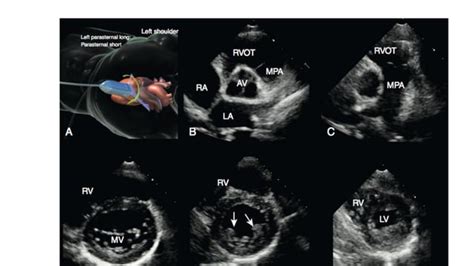 Echocardiography Of Mitral Valve Surgeons Perspective Ppt Free