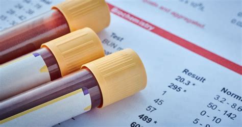 Shbg Hormone Levels How Diet And Your Lifestyle Influence It