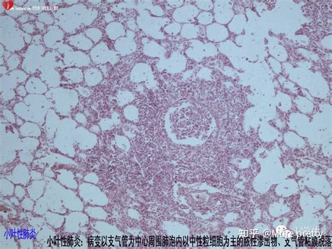 病理切片考试总结 知乎