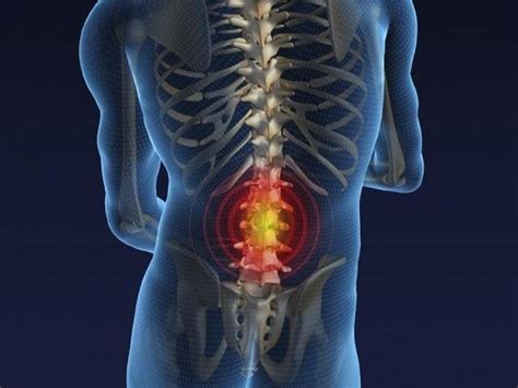 ¿qué Es Una Hernia Discal Lumbar Y Cómo Se Manifiesta Top Doctors