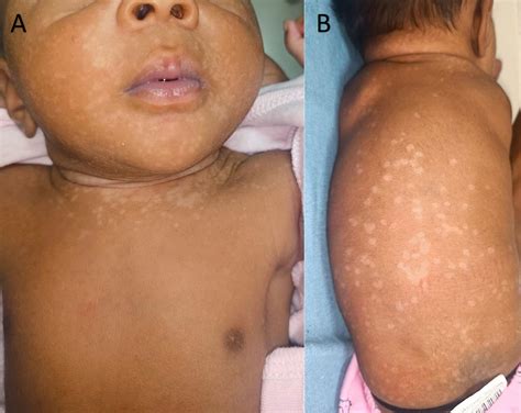 Multiple Hypopigmented Macules In A Neonate Bmj Case Reports