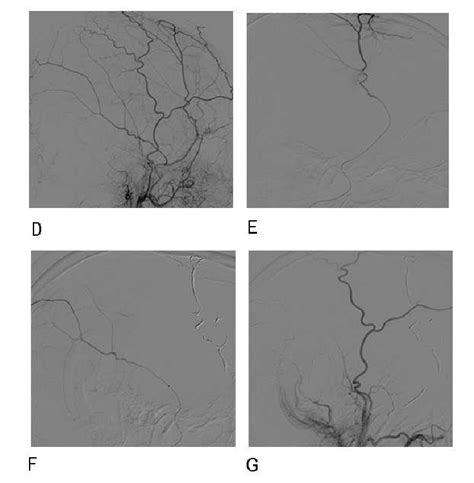 Example Of A Left Sided Csdh Receiving Middle Meningeal Artery Mma
