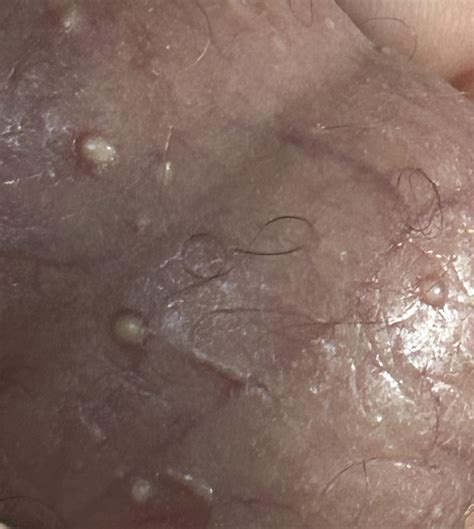 Anyone Know What These Are R Pimplepoppingfans