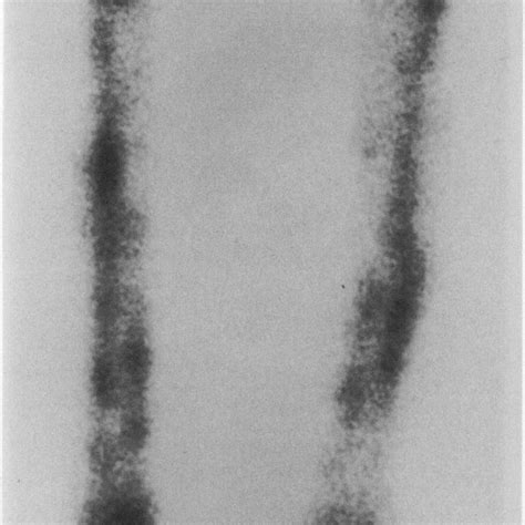 99 Tc Technetium Radionuclide Bone Scan Showing Increased Uptake In