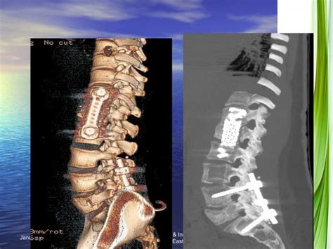 Thoracolumbar Fractures Anterior Column Reconstruction Ppt