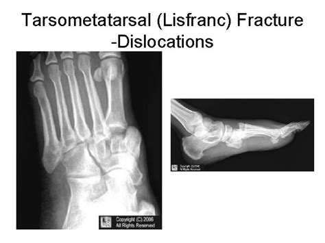 Fatigue Fractures Radiography Tarsometatarsal Lisfranc Fracture Dislocations Talar