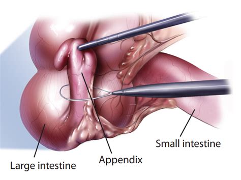 Appendectomy Acs