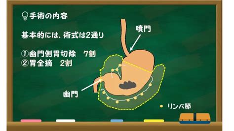 パンダ先生の病気の学校、胃がんで手術と言われたら パンダ先生の病気の学校