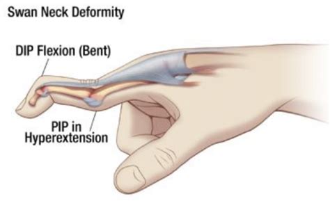 Swan Neck Deformity Teton Hand Surgery