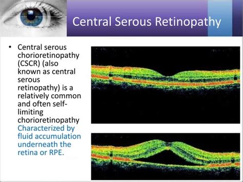 Opticalocular Coherence Tomography Oct All In One Presentation Pptx