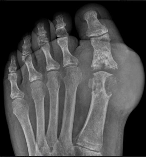 Arthritis Of The Foot And Ankle Treatment Foot Doctor Southlake